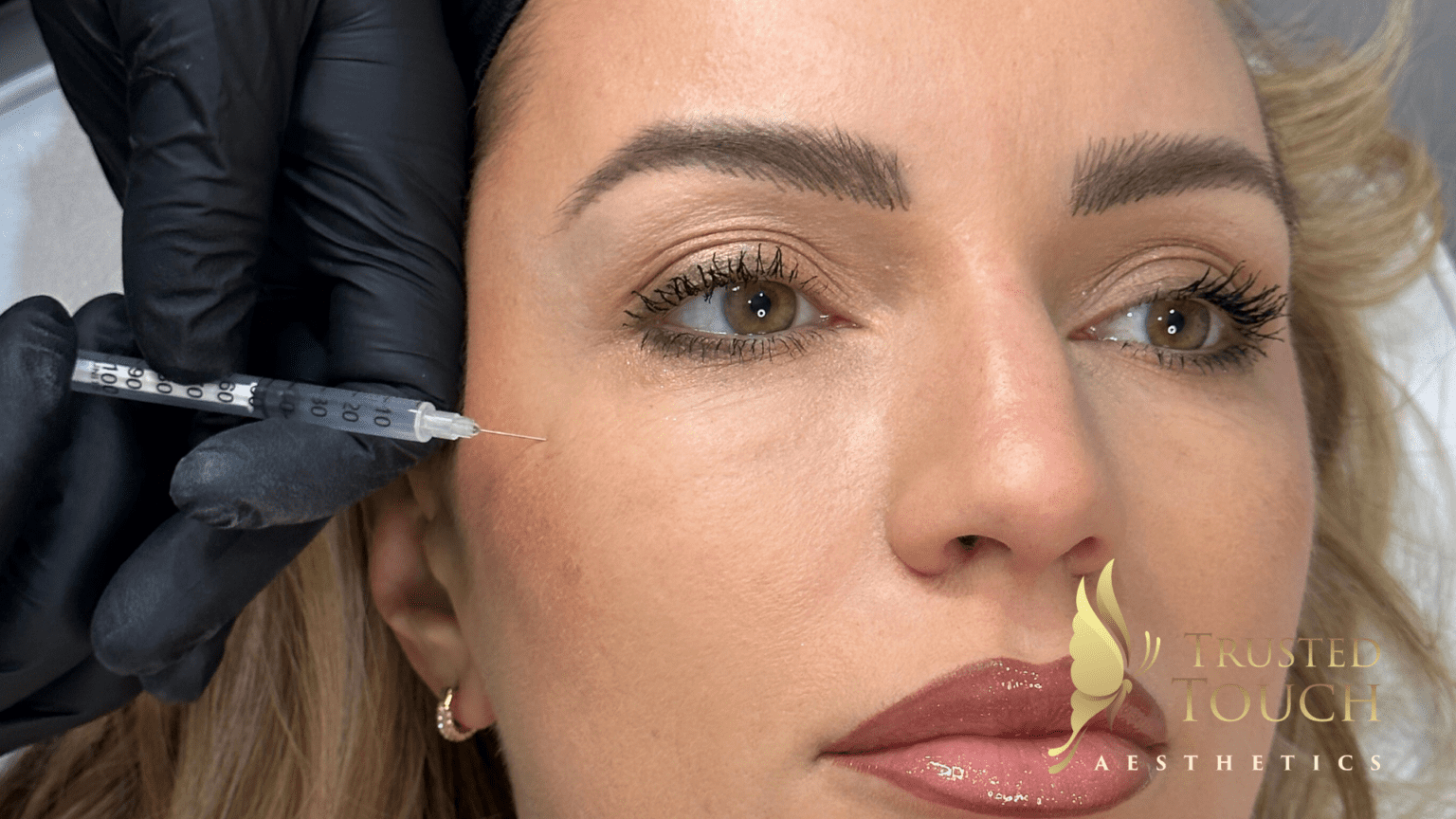 Cheek Fillers - Botox and fillers Trusted touch aesthetics, Fulham.